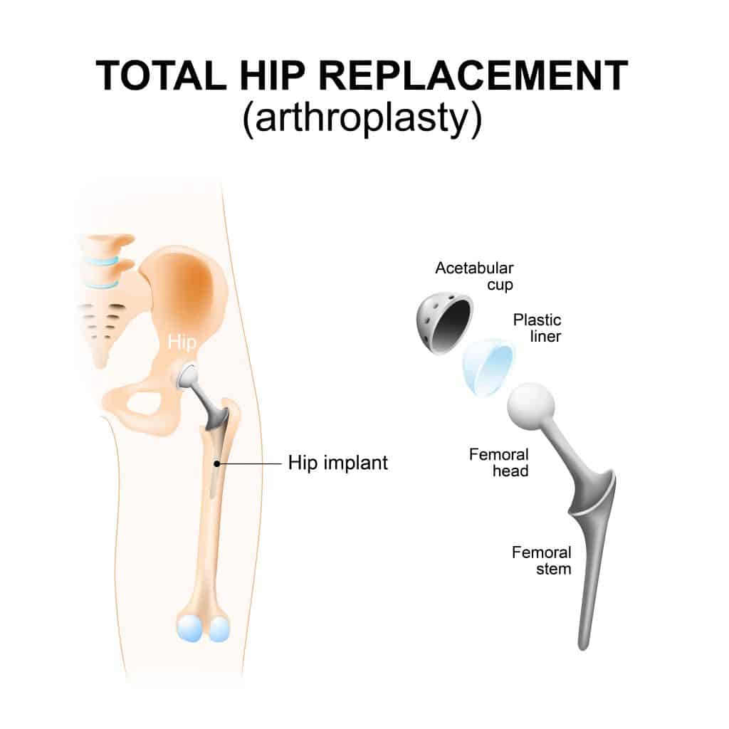 ERAS Total Hip Replacement in Singapore - Surgery & Specialist