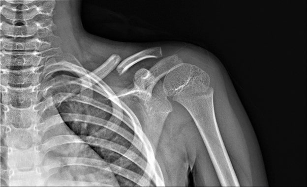Clavicle Fractures | Shoulder Specialist Singapore