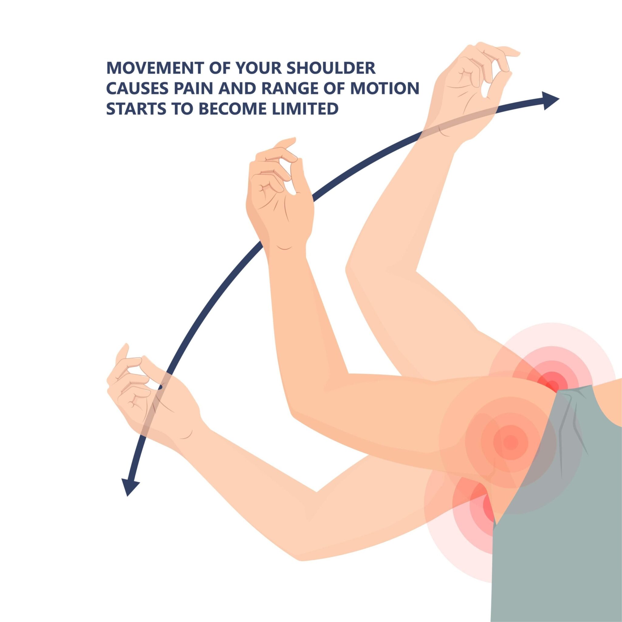 Shoulder Fractures | Shoulder Specialist Singapore