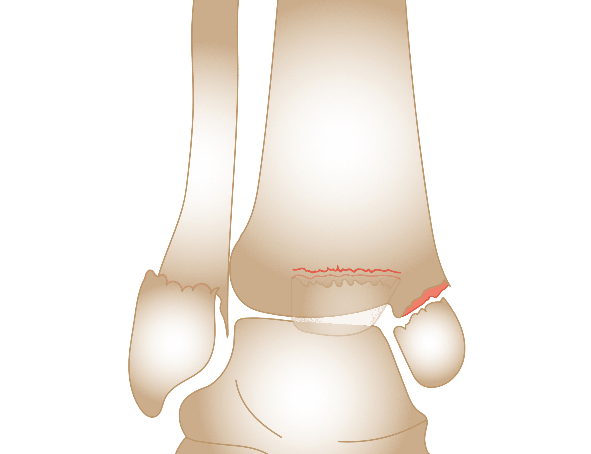 Ankle Fracture Treatment in Singapore | Symptoms & Causes