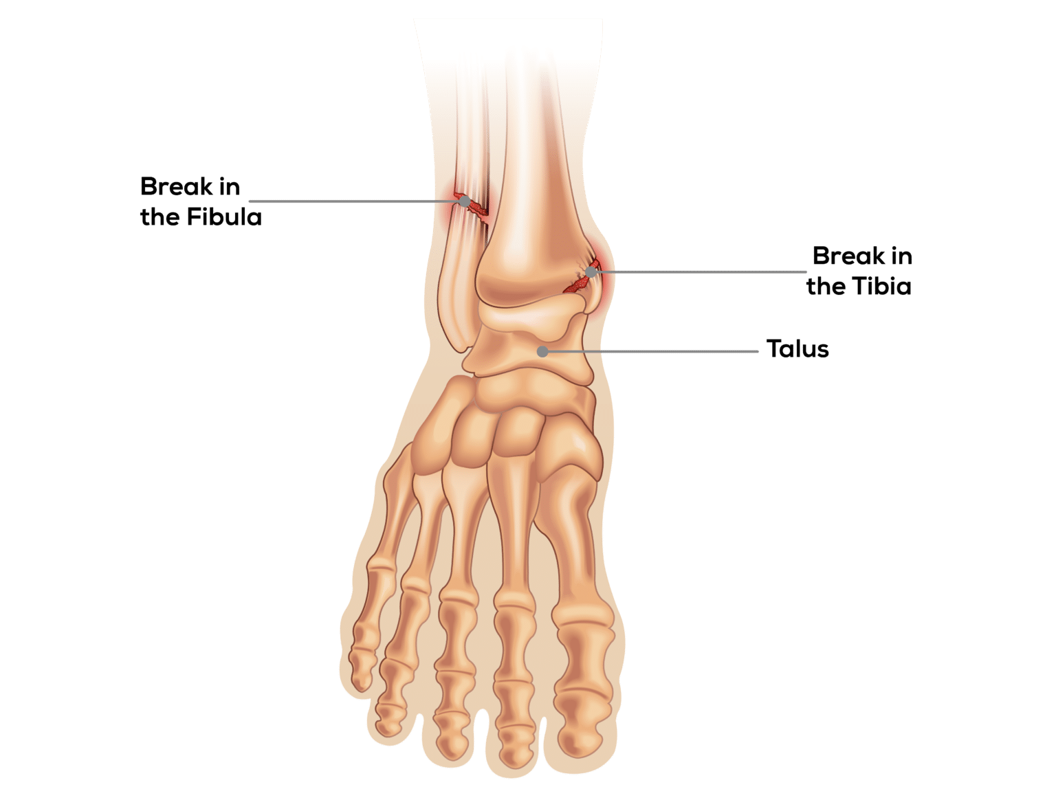 Ankle Fracture Treatment in Singapore | Symptoms & Causes