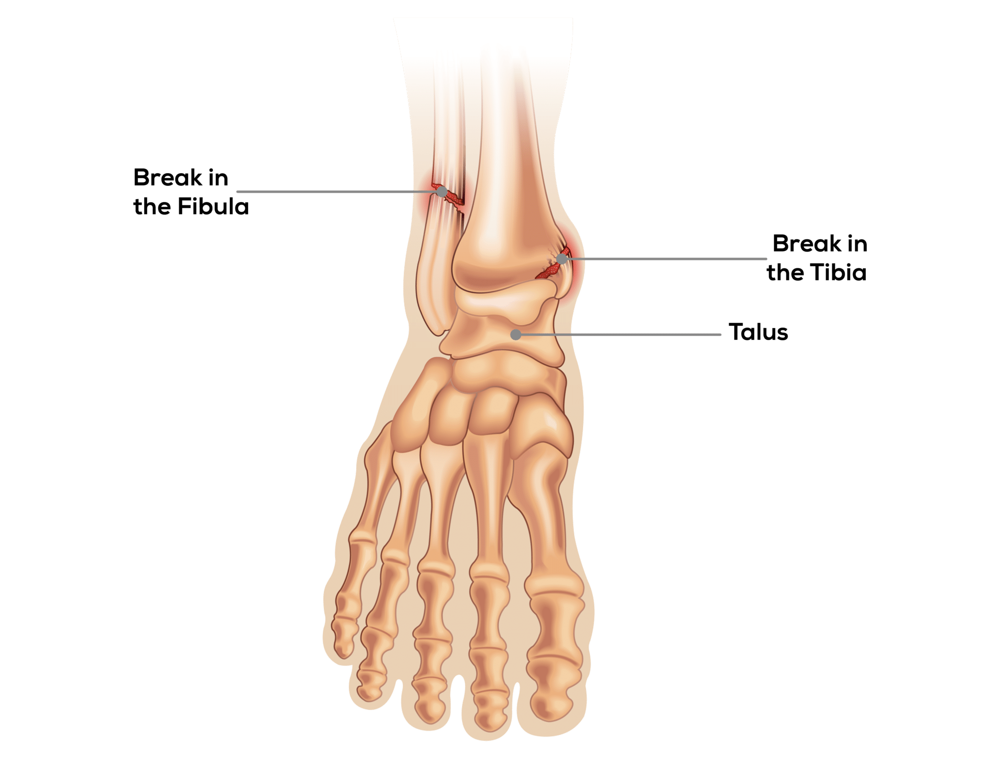 Ankle Fracture Treatment in Singapore | Symptoms & Causes