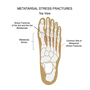 Comprehensive Guide to 5th Metatarsal Fractures: Symptoms, Treatment ...